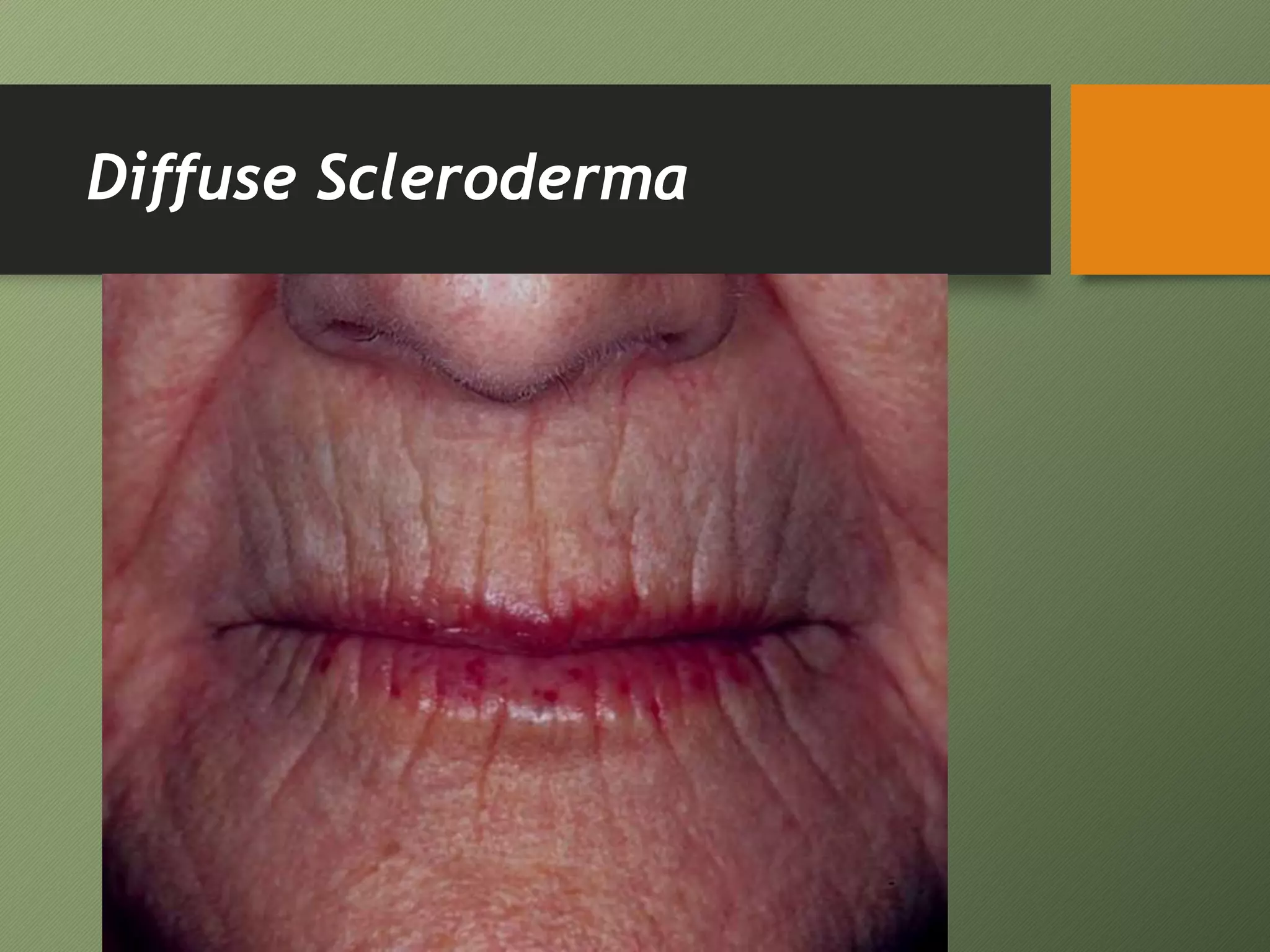 Scleroderma | PPTX
