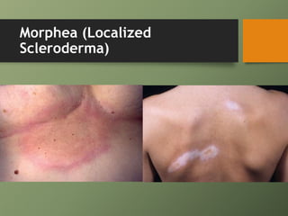 Scleroderma | PPTX