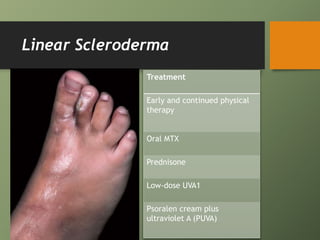 Scleroderma | PPTX