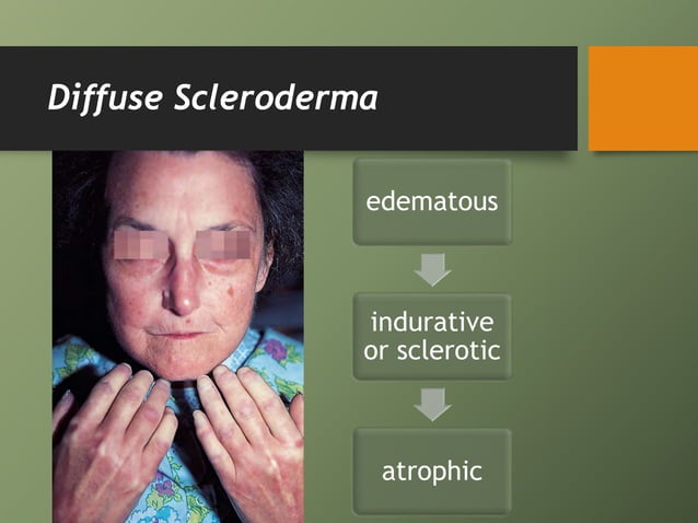Scleroderma | PPTX | Skin and Dermatology | Diseases and Conditions