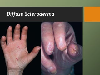 Scleroderma | PPTX