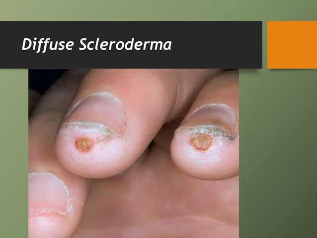 Scleroderma | PPTX | Skin and Dermatology | Diseases and Conditions