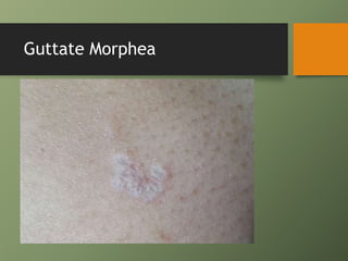 Guttate Morphea