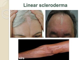 Crest Scleroderma Scalp