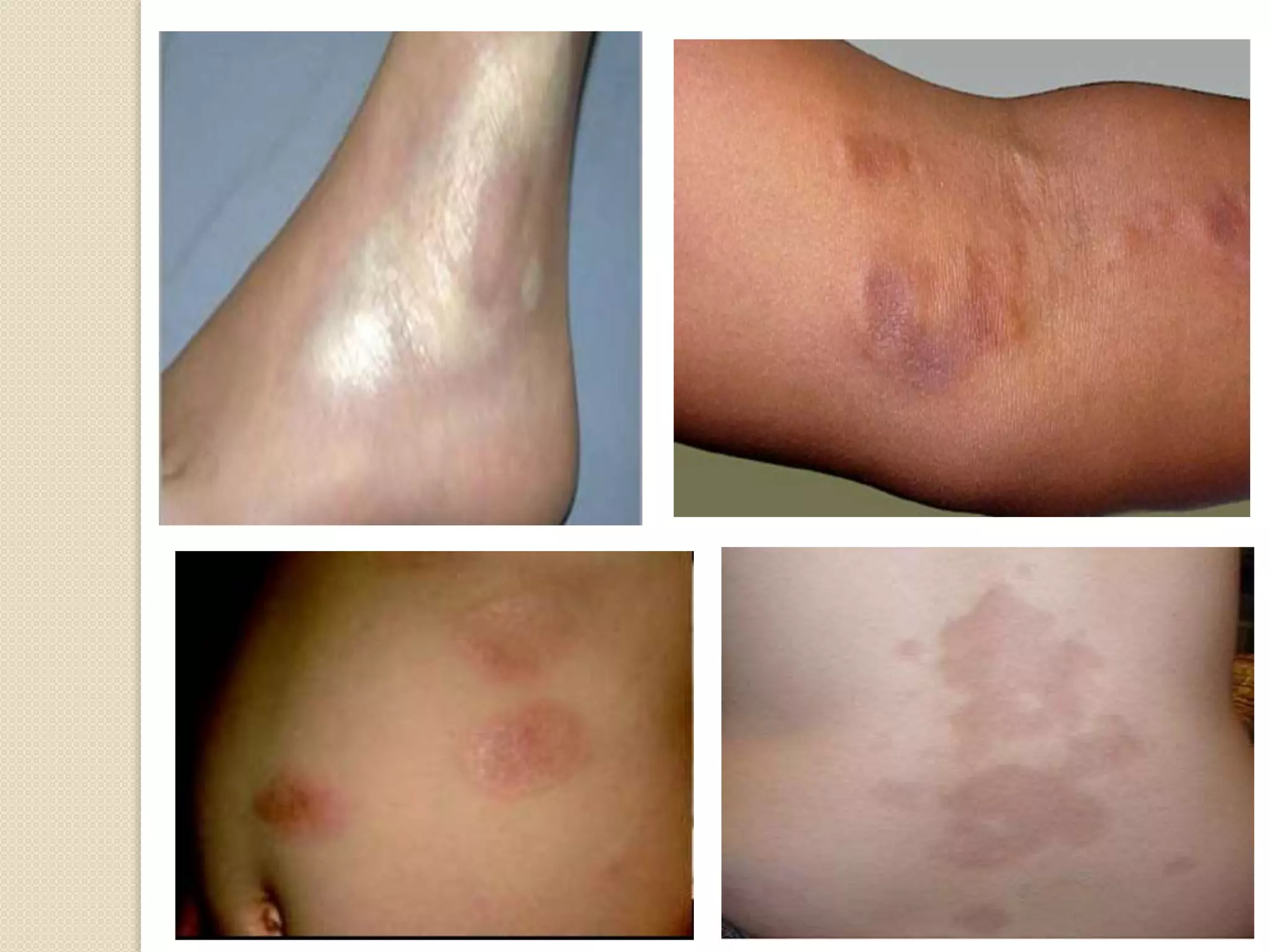 scleroderma-191009073259 (1).pdf