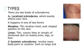 Scleroderma | PPTX