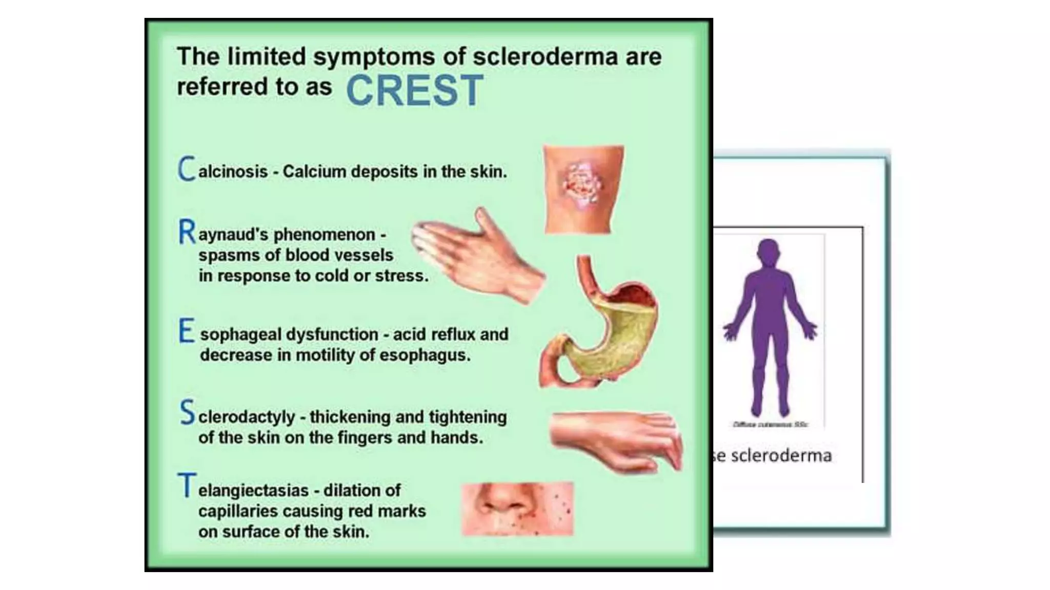 Scleroderma | PPTX