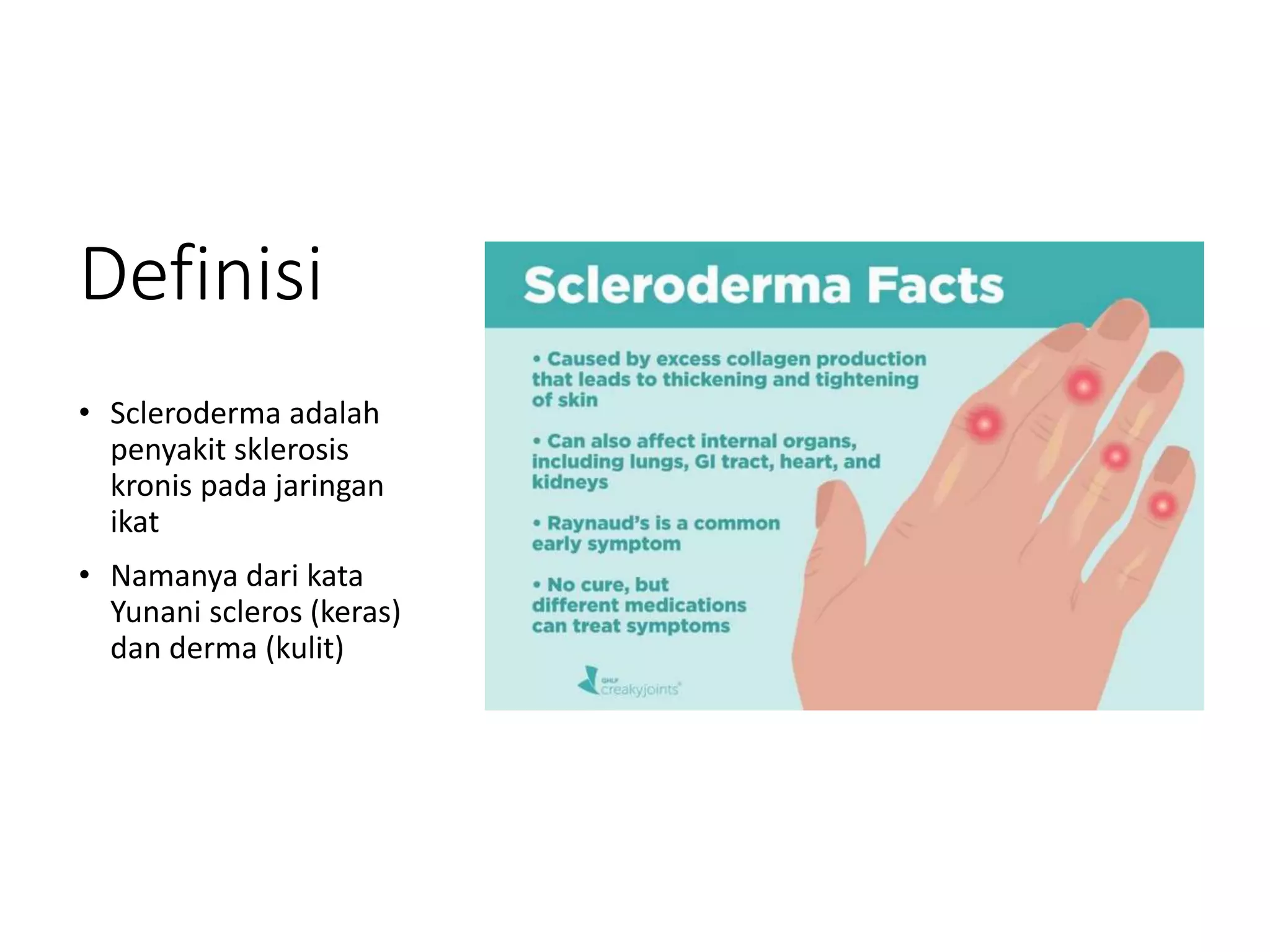 Scleroderma.1.pptx