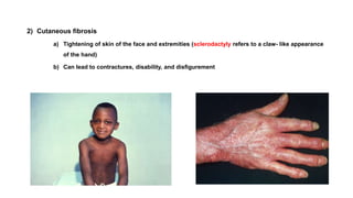 Scleroderma.pptx
