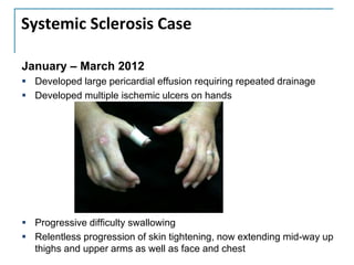 scleroderma.pptx