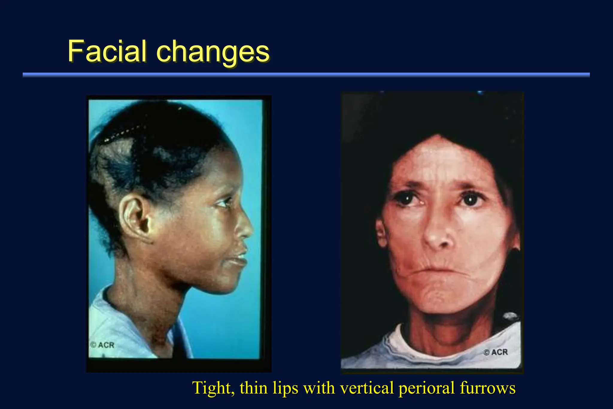 scleroderma disease - connective tissues | PPTX