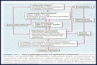scleroderma disease - connective tissues | PPTX