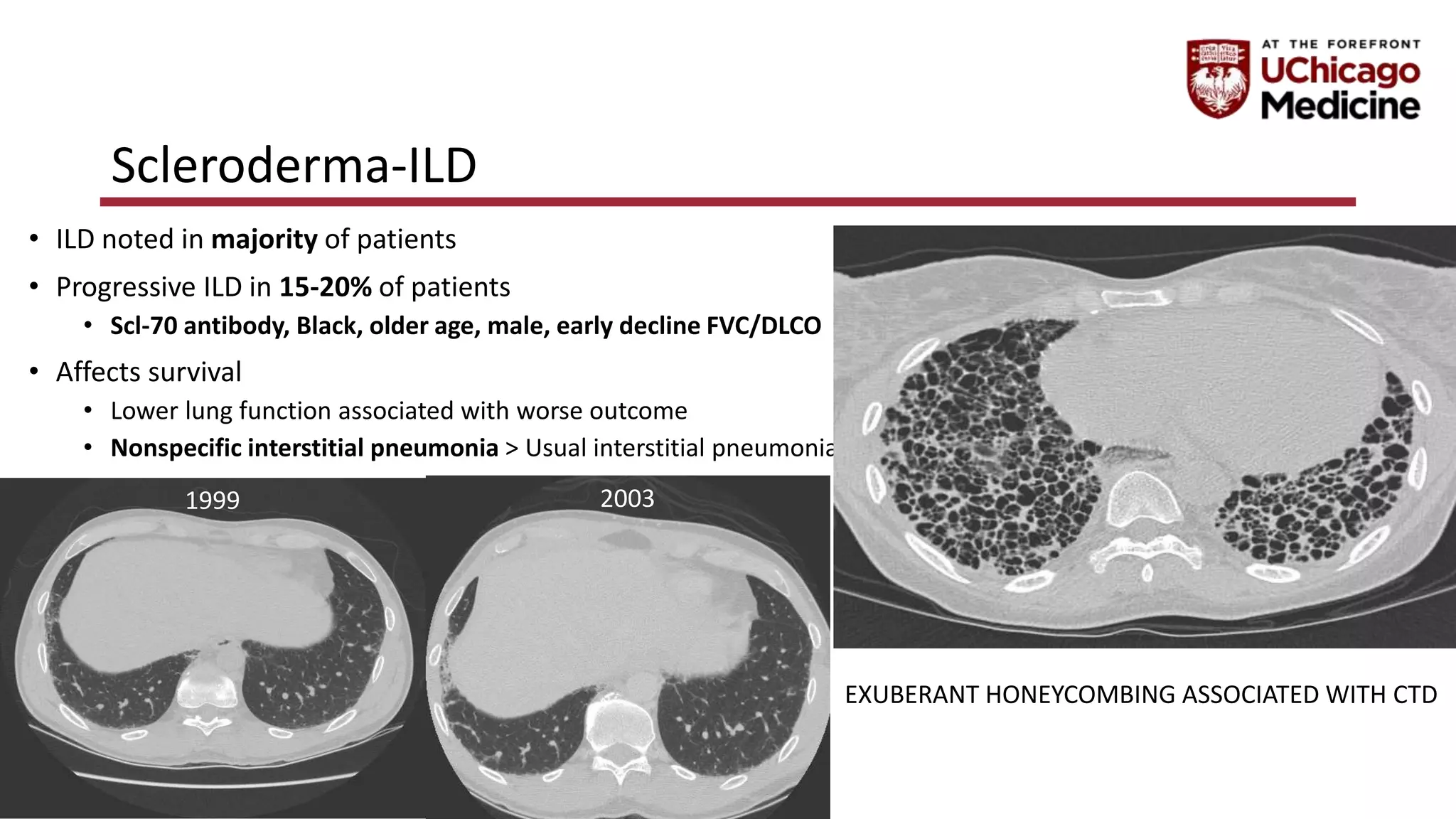 Scleroderma Lung Disease: Best Practices for Monitoring and Treatment ...
