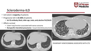 Scleroderma Lung Disease: Best Practices for Monitoring and Treatment ...
