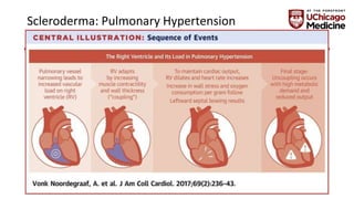 Scleroderma Lung Disease: Best Practices for Monitoring and Treatment ...