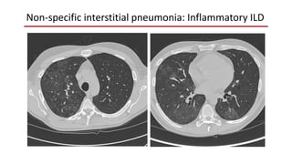 Scleroderma Lung Disease: Best Practices for Monitoring and Treatment | PPT