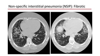 Scleroderma Lung Disease: Best Practices for Monitoring and Treatment | PPT