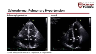Scleroderma Lung Disease: Best Practices for Monitoring and Treatment | PPT