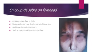 Scleroderma dermatology | PPTX