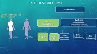 Current Advancements in Scleroderma Treatment | PPTX