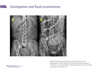 Scleroderma and the Gastrointestinal Tract and Gut Health | PDF