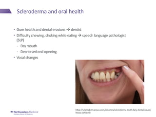 Scleroderma and the Gastrointestinal Tract and Gut Health | PPT