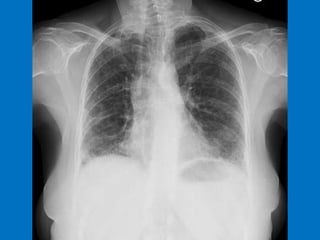 Scleroderma Interstitial Lung Diseases - What they are and what's new | PPT