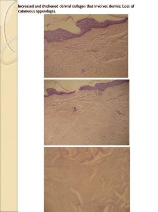 Scleroderma secondary to silica exposure dr n.s.ramburn | PPT