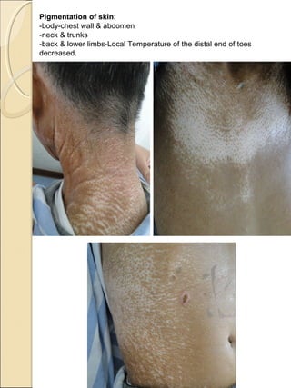 Scleroderma secondary to silica exposure dr n.s.ramburn | PPT