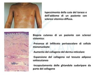 Sclerodermia e Sclerosi Sistemica - SCAN Onlus | PPT