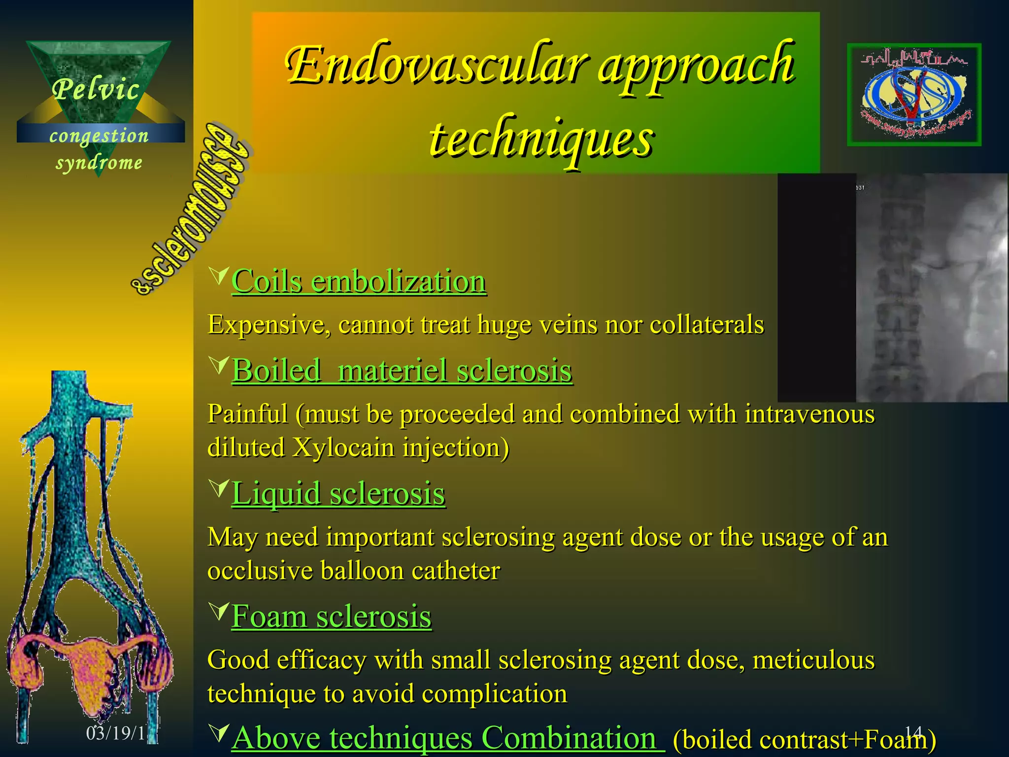 Scleromousse in the treatment of pelvic congestion syndrome | PPT