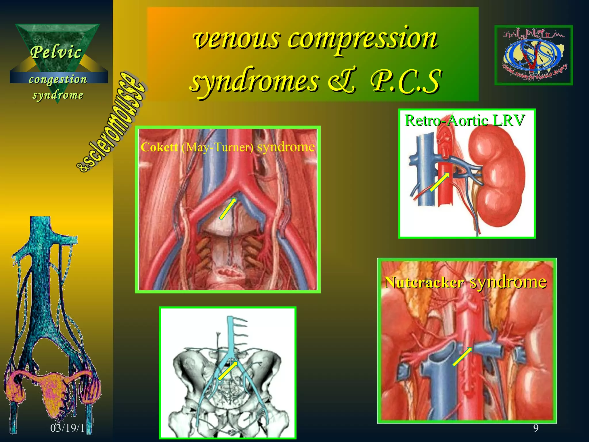 Scleromousse in the treatment of pelvic congestion syndrome | PPT