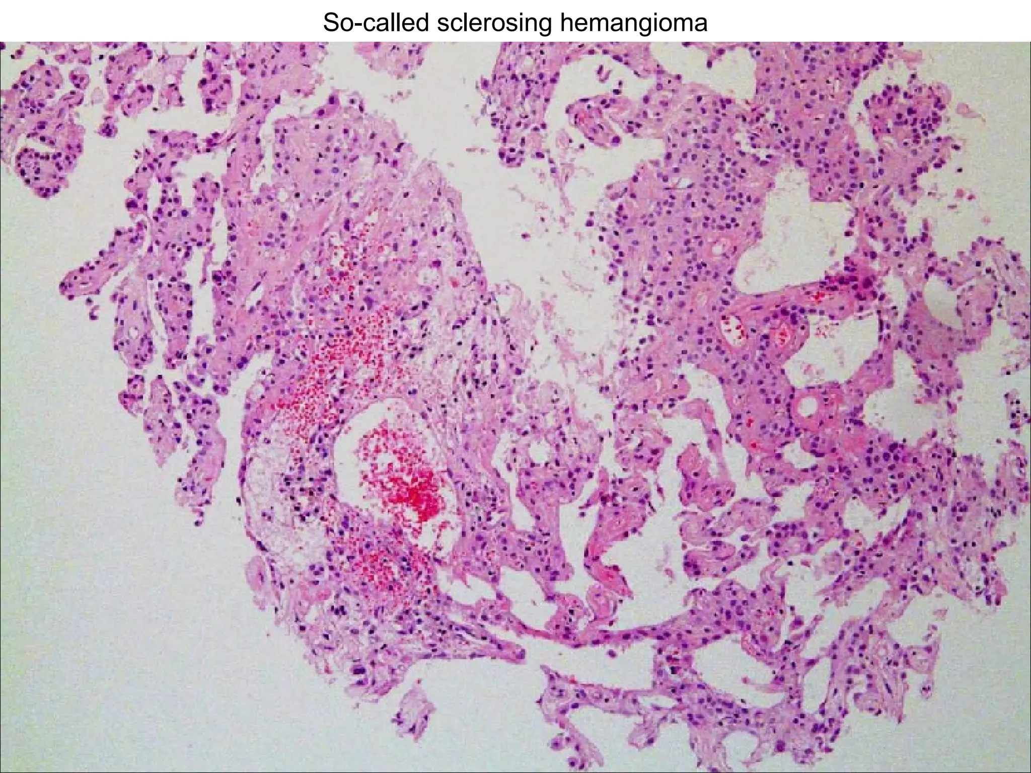 Sclerosing Hemangioma | PPS