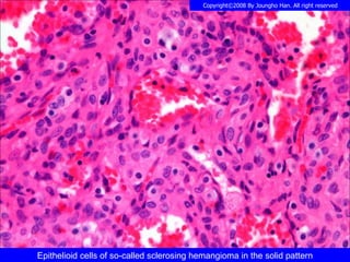 sclerosing hemangioma | PPT