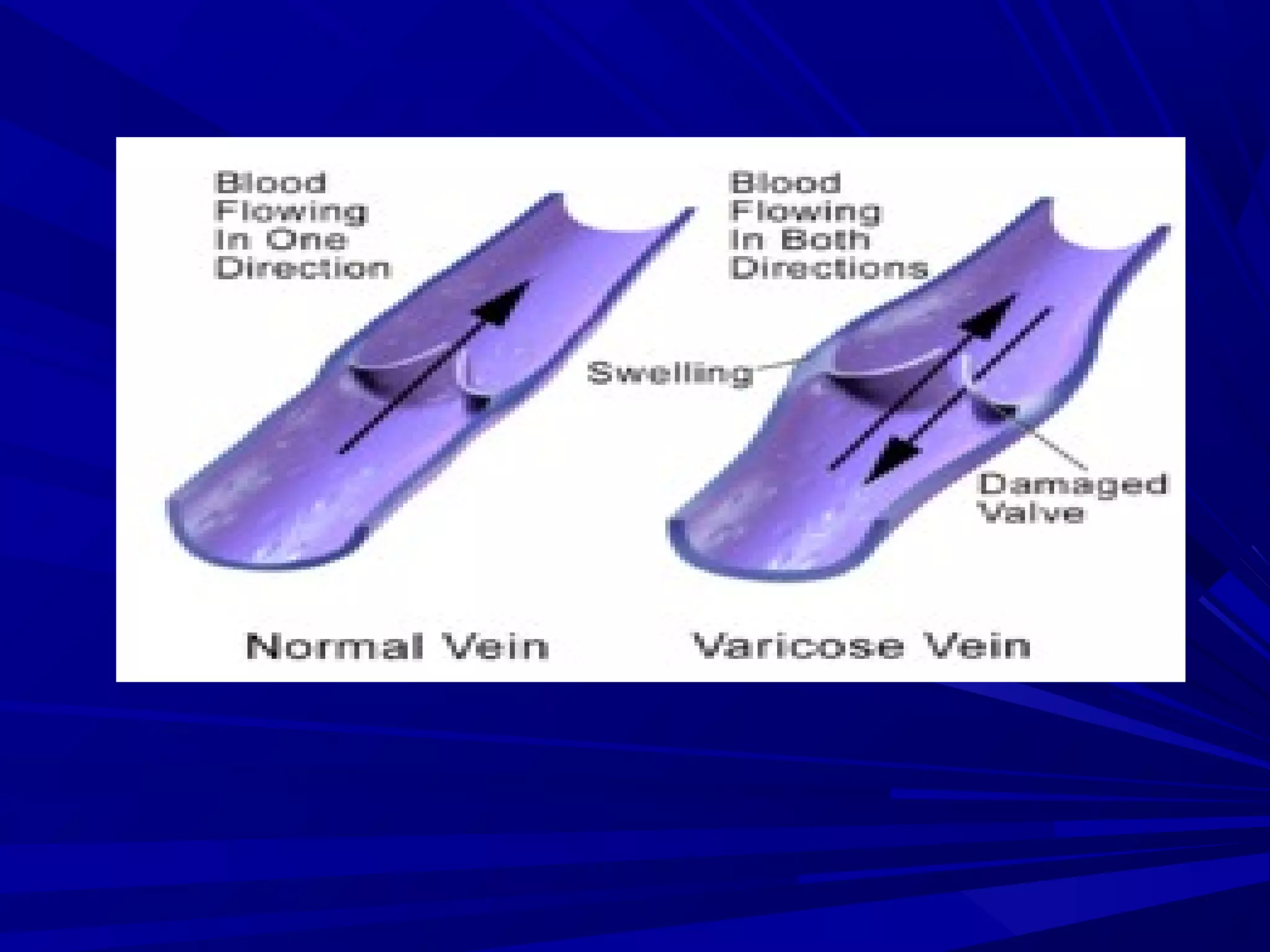 Sclerosing agents | PPT