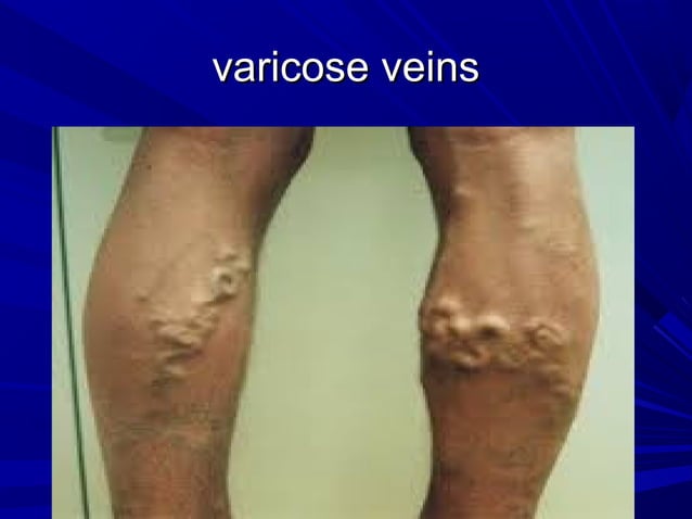 Sclerosing agents | PPT