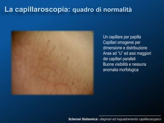 Sclerosi sistemica diagnosi ed inquadramento capillaroscopico | PPTX ...