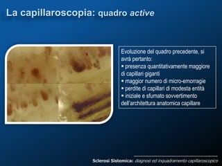Sclerosi sistemica diagnosi ed inquadramento capillaroscopico | PPTX ...