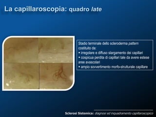Sclerosi sistemica diagnosi ed inquadramento capillaroscopico | PPTX ...