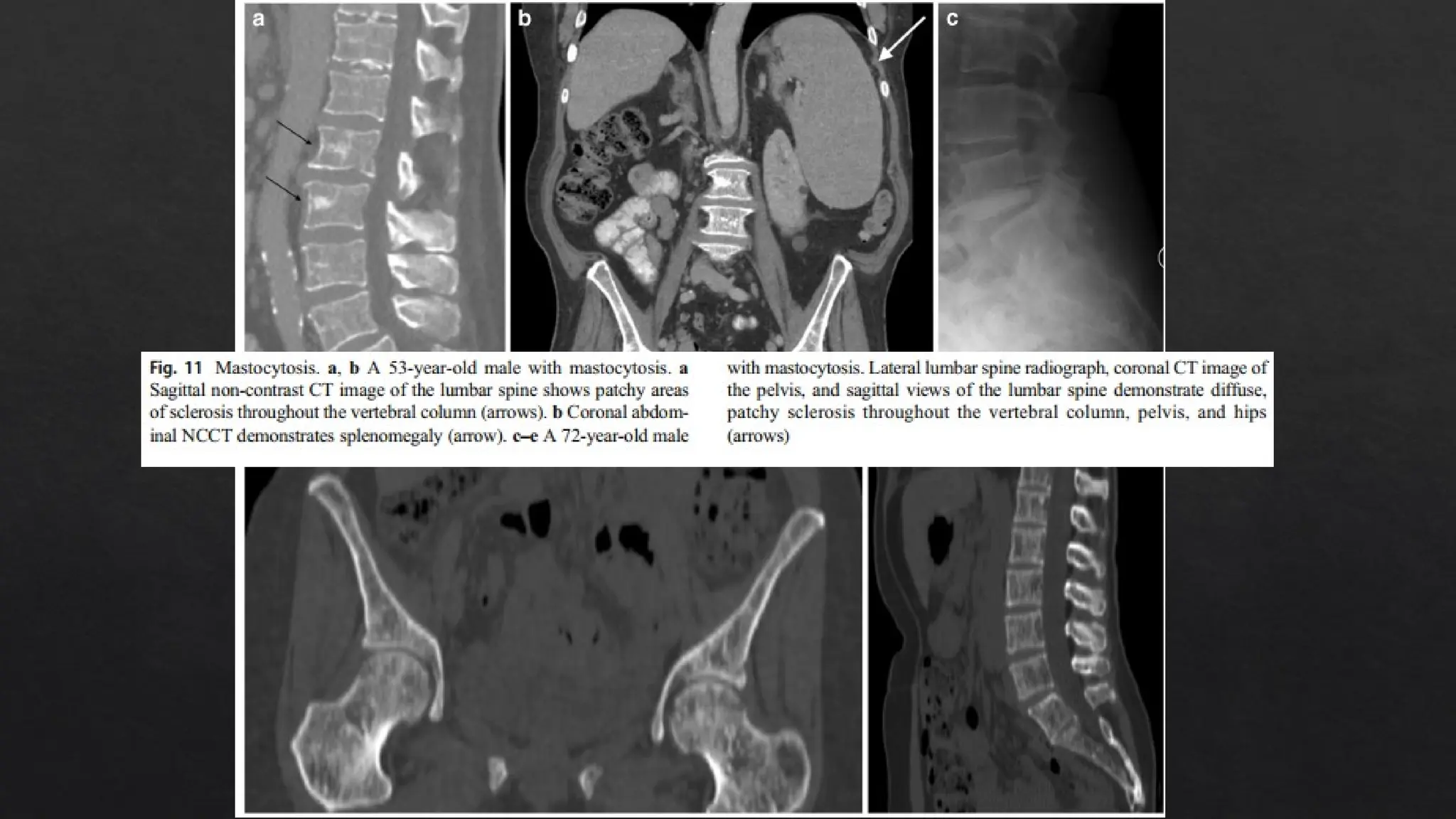 Sclerotic bone lesions caused by non-infectious and non-neoplastic.pptx