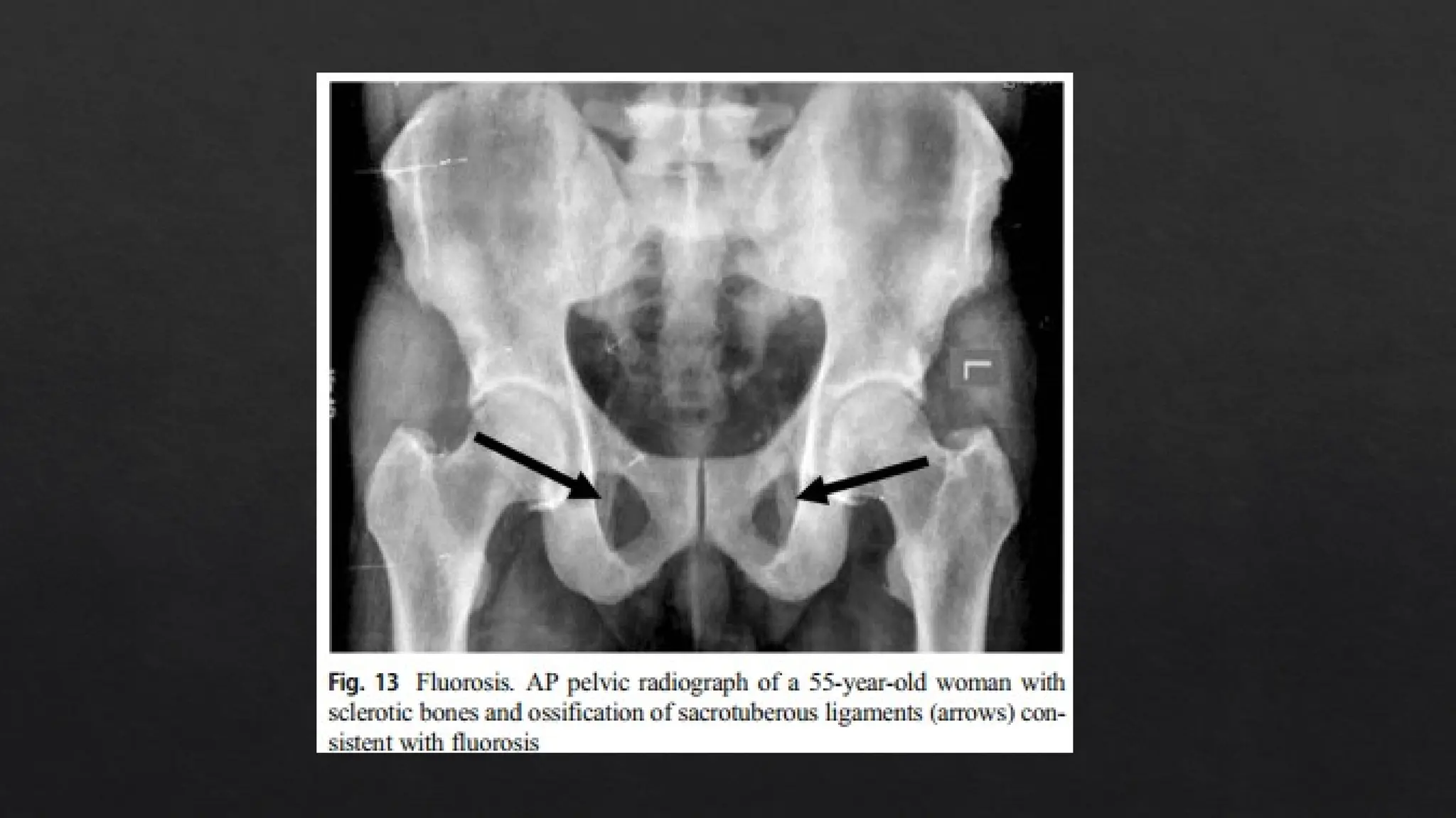 Sclerotic bone lesions caused by non-infectious and non-neoplastic.pptx