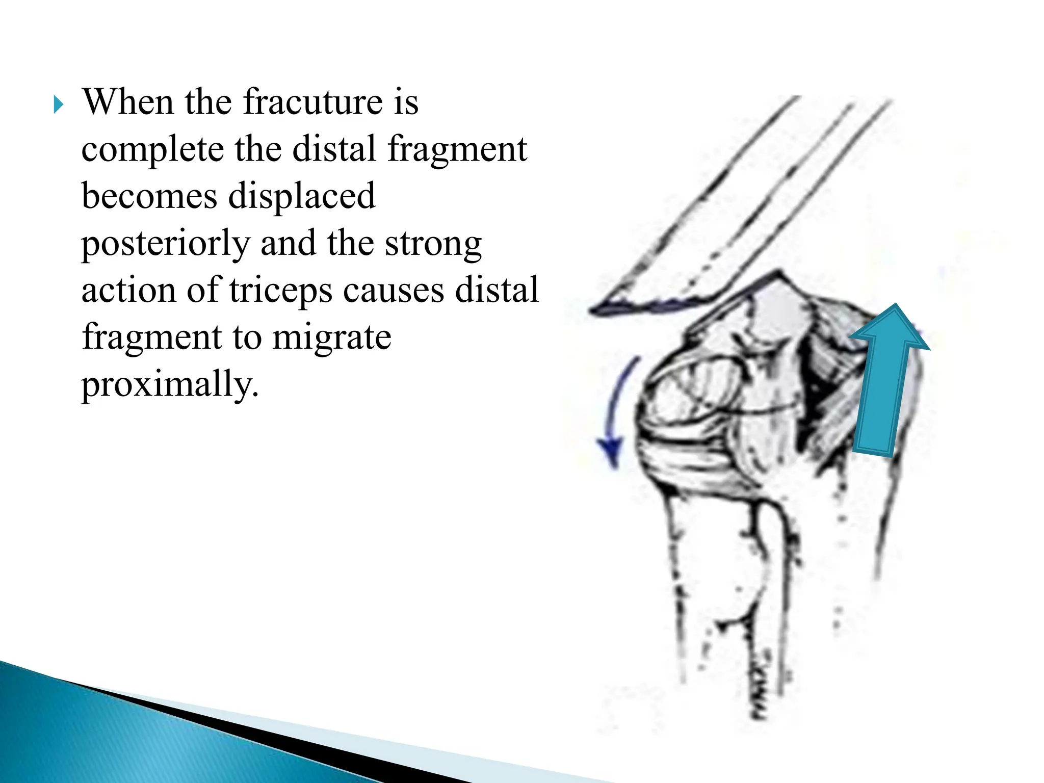 Supra condylar humerus fracture in children | PPTX