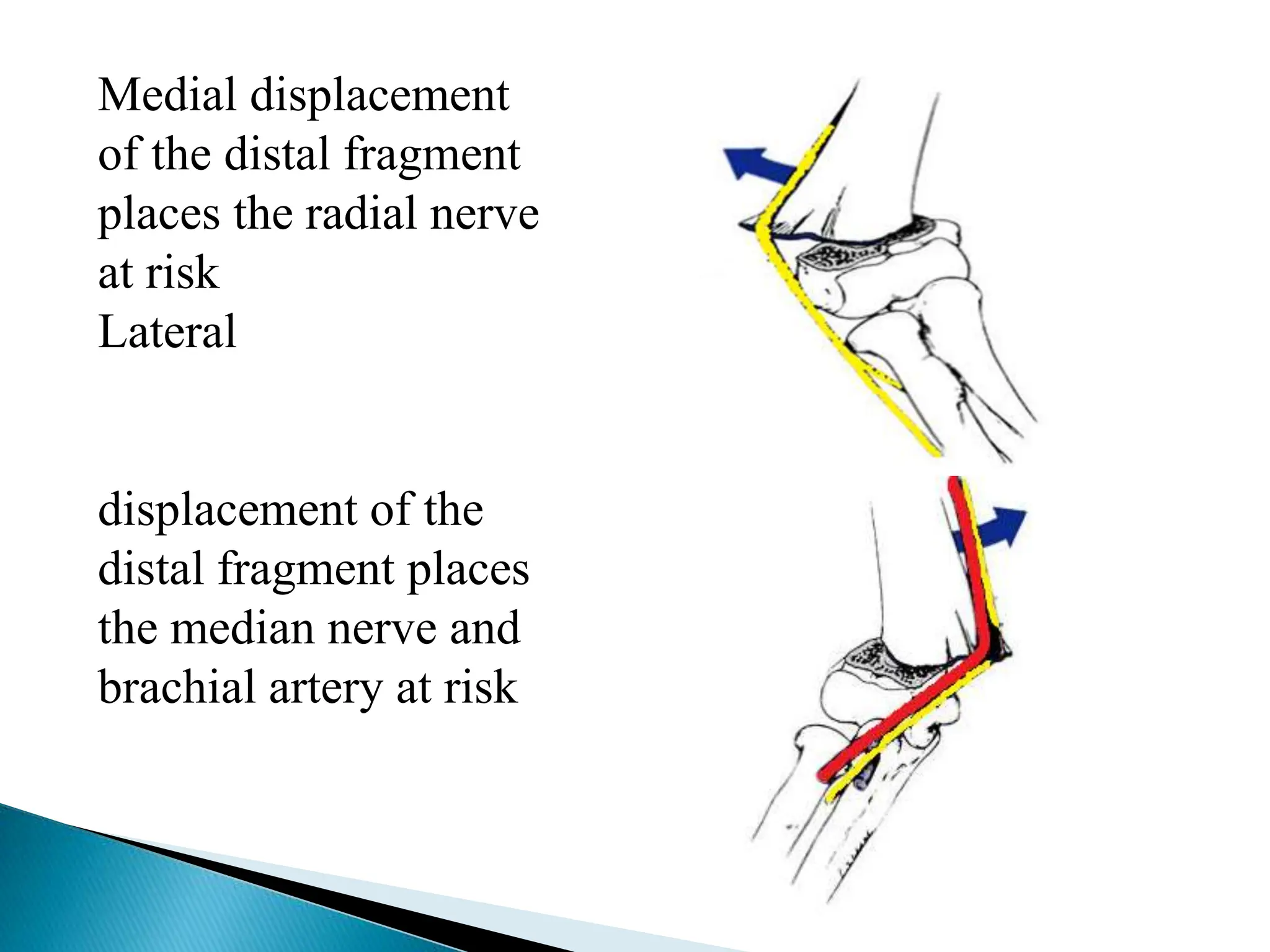Supra condylar humerus fracture in children | PPTX