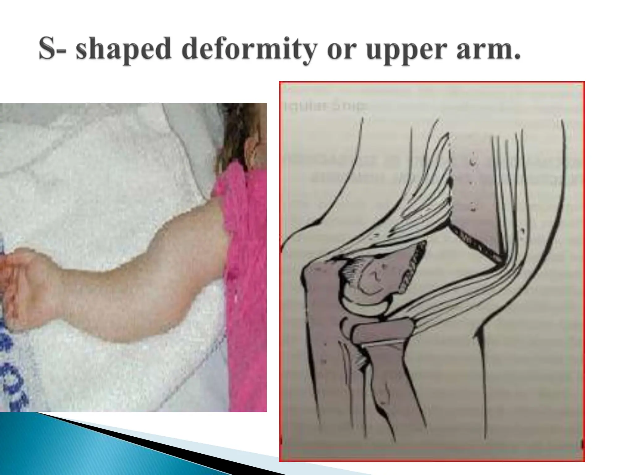 Supra condylar humerus fracture in children | PPTX
