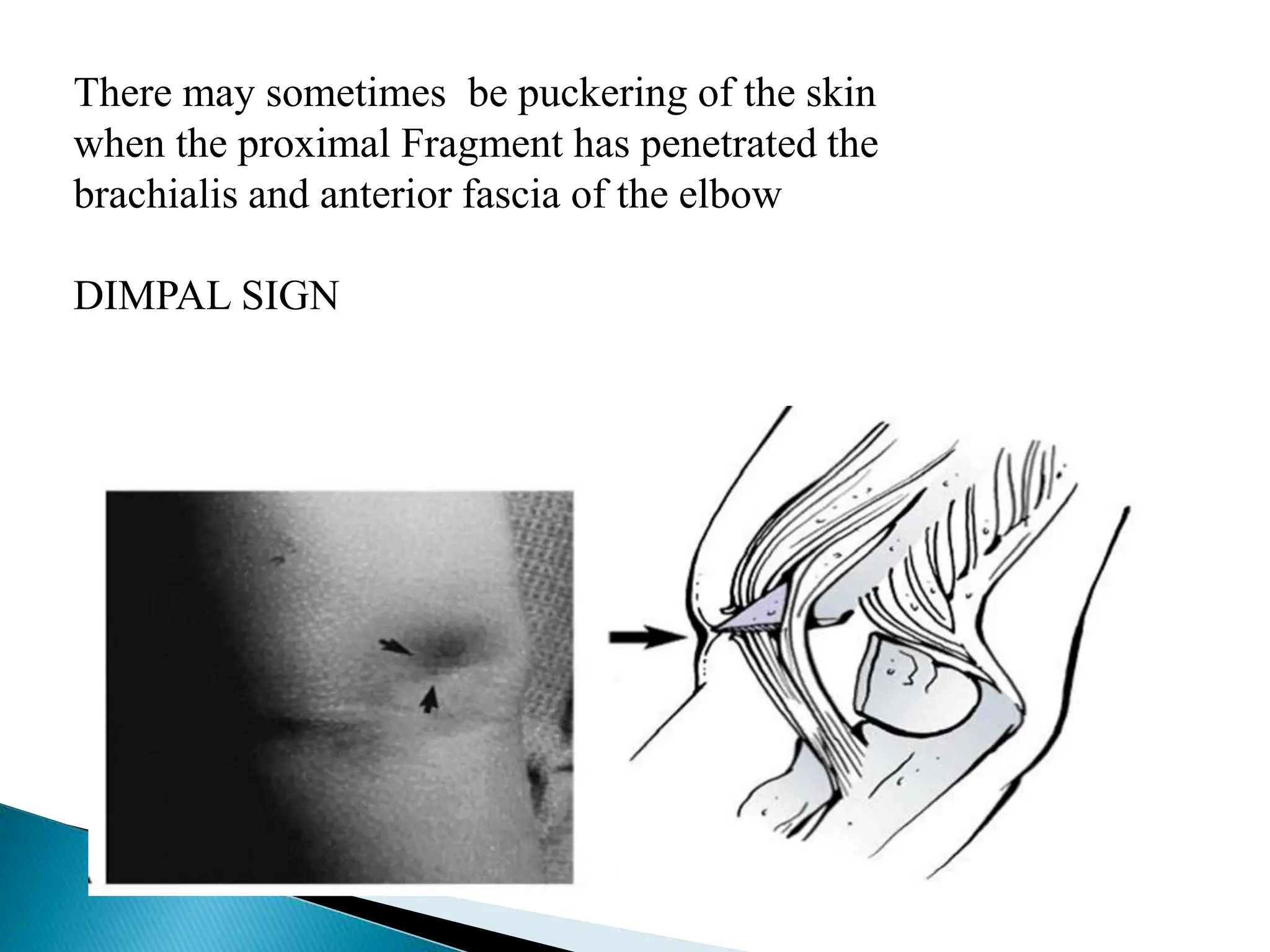 Supra condylar humerus fracture in children | PPTX