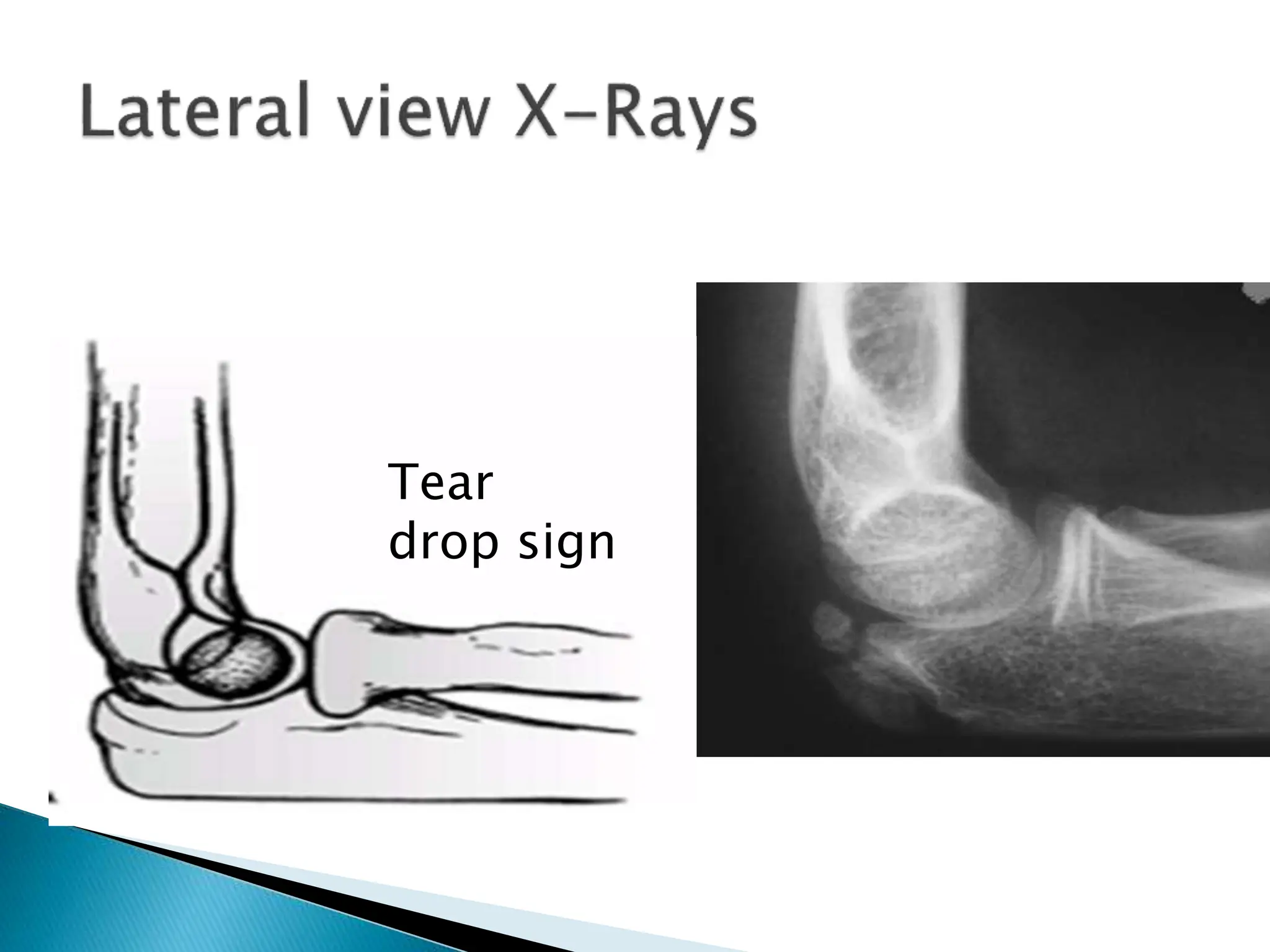 Supra condylar humerus fracture in children | PPTX