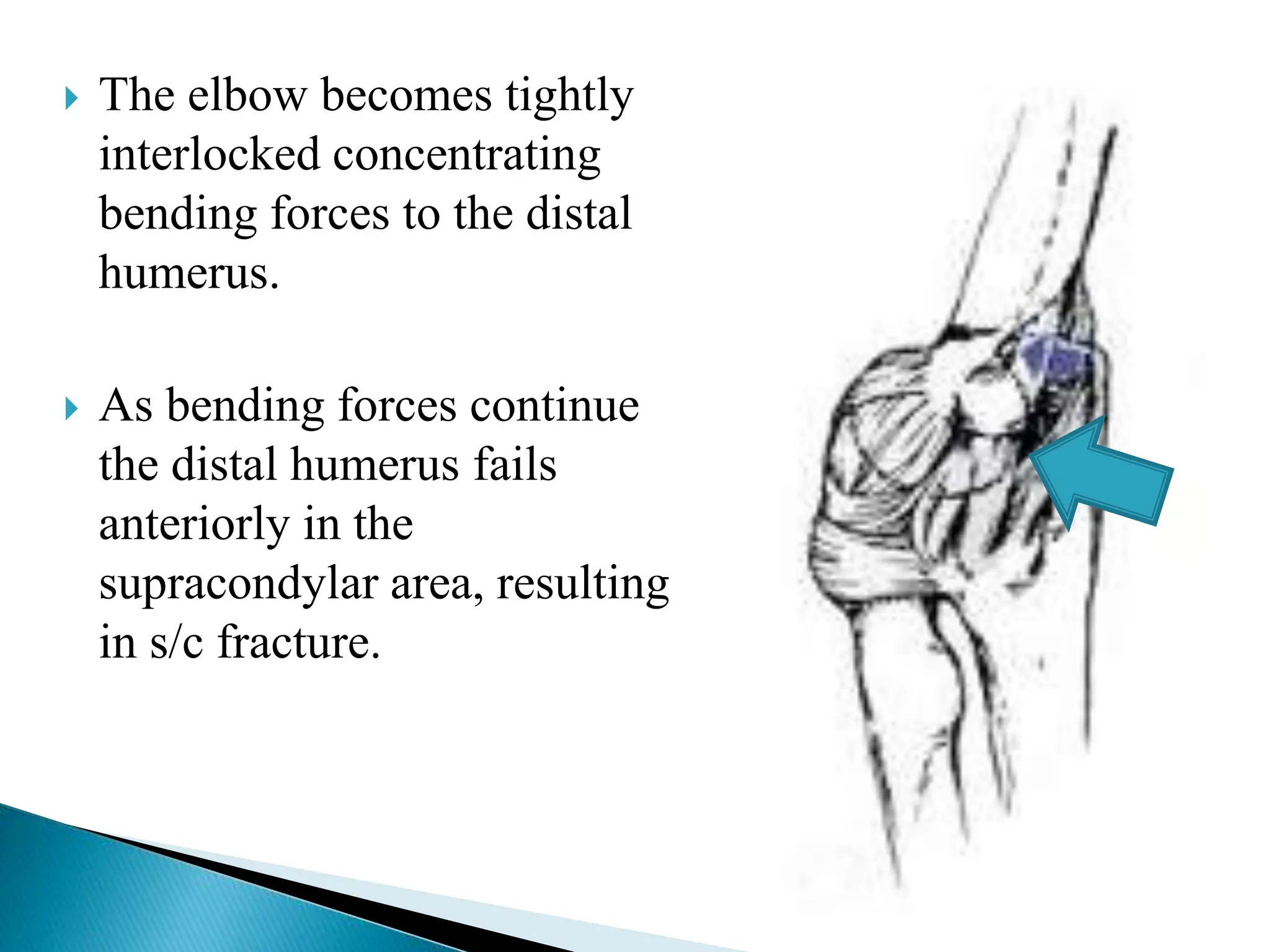 Supra condylar humerus fracture in children | PPTX