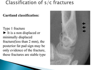 Supra condylar humerus fracture in children | PPTX