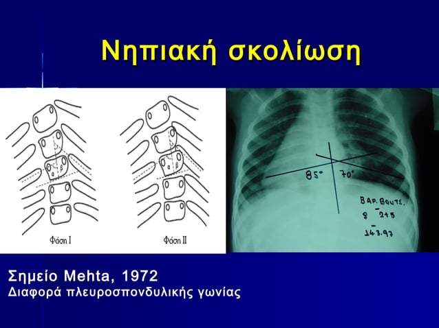 Παραμορφώσεις της Σπονδυλικής Στήλης «Σκολίωση» - Scoliosi 2009 | PPT