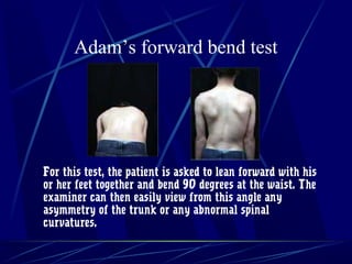 Scoliosis | PPT | Physical Therapy | Wellness